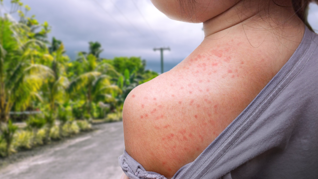 ИЈЗ: Вкупно 903 лица со овчи сипаници во јануари, 19-годишно лице од ...